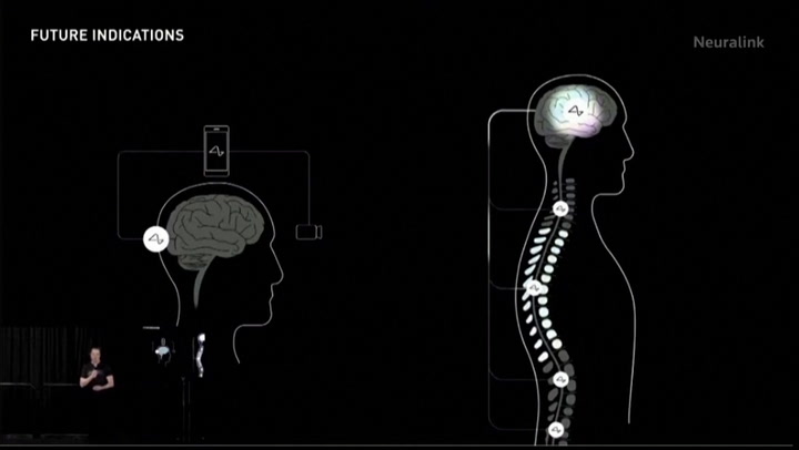 National Post | Musk'S Neuralink Says The Fda Approved Human Trials